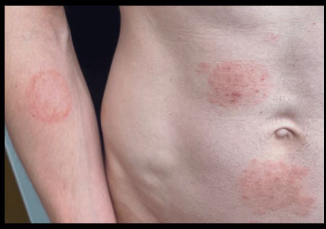New ‘Ringworm’ Outbreak Turns Minnesota Into America’s STD Fungus Hotspot